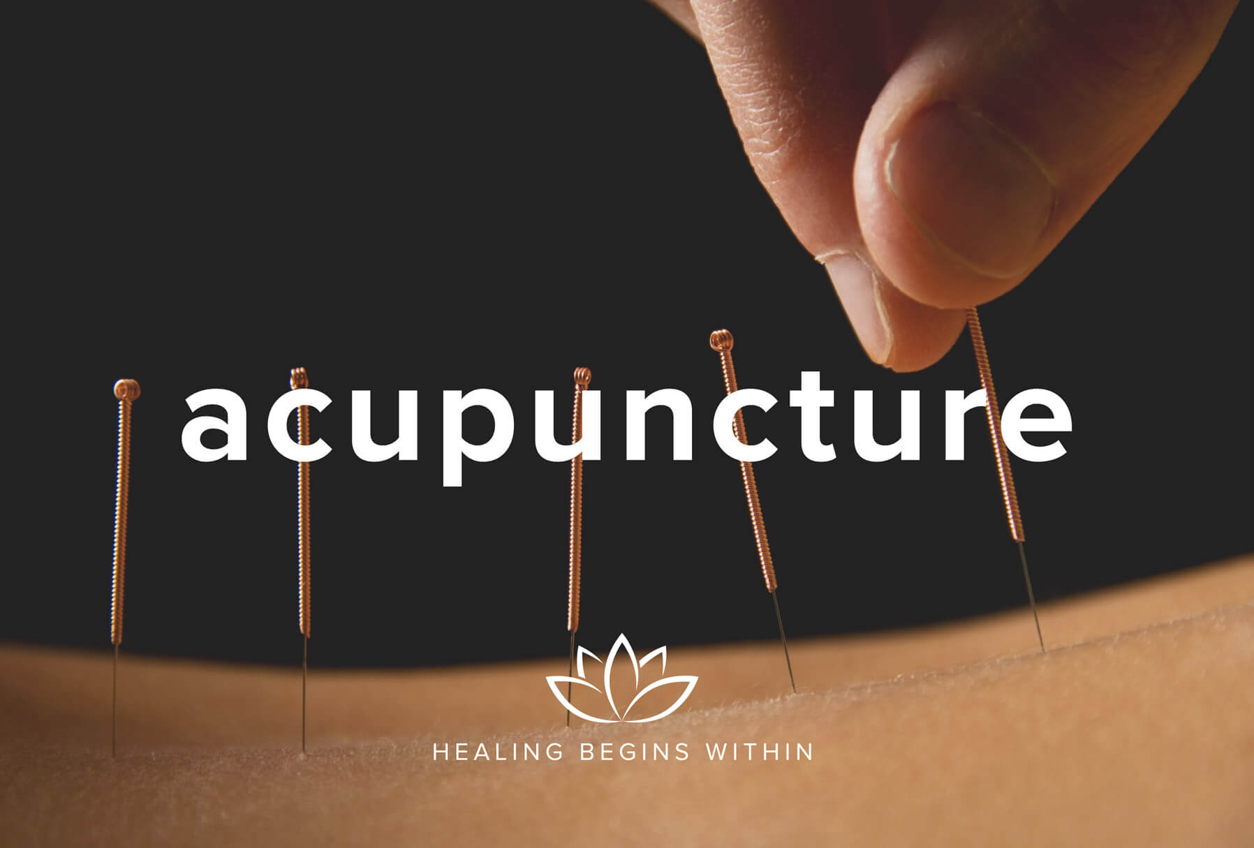 Acupuncture – Greenacres Surgery